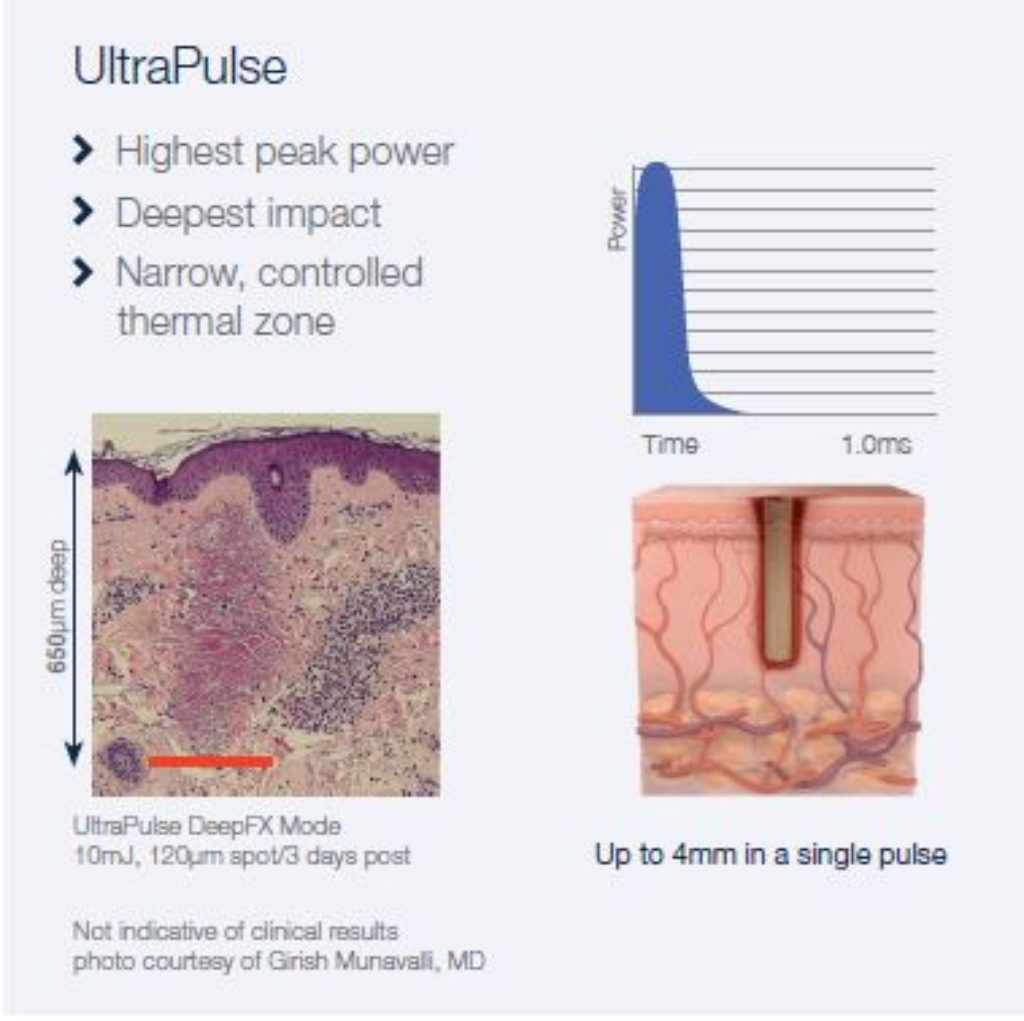 UltraPulse - Technology